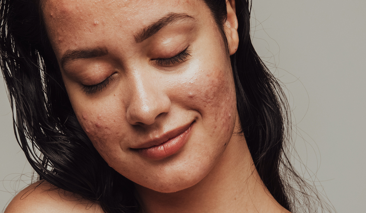 How To Treat Acne - From The Experts - The Handbook