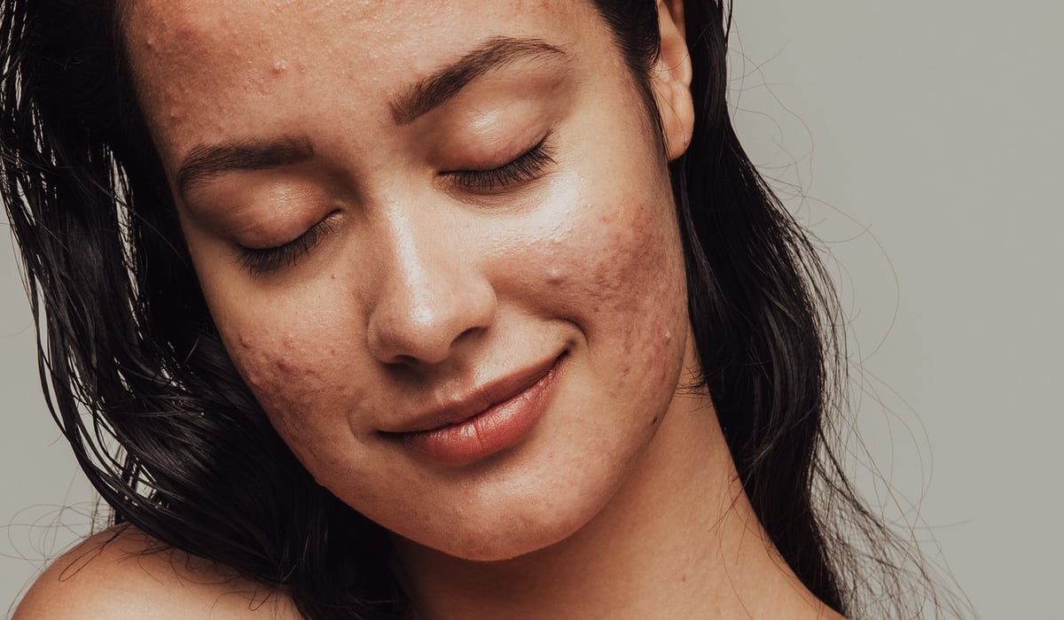How To Treat Acne - From The Experts - The Handbook